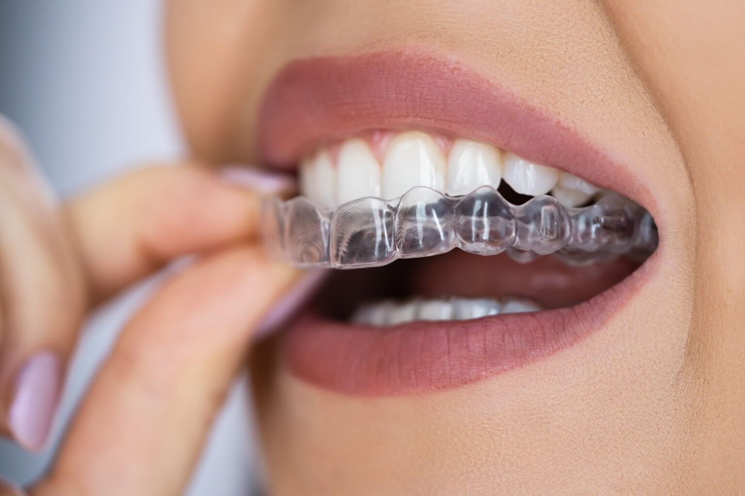 How Does Invisalign Work? - Zuroff Orthodontic Care